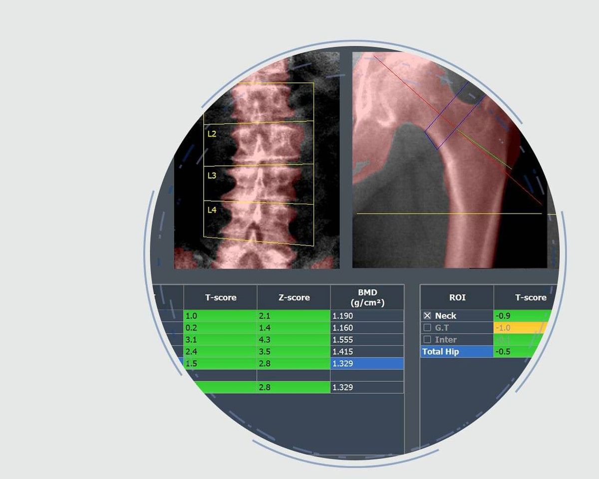 Bone Density Scan | Bone & Body Blueprint Ltd