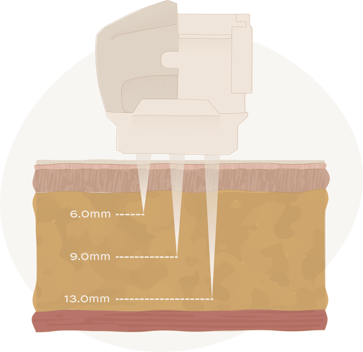 HIFU - High Intensity Micro-Focused Ultrasound | The Refinery Room