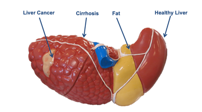 Your Liver | The Hepatitis Foundation of New Zealand
