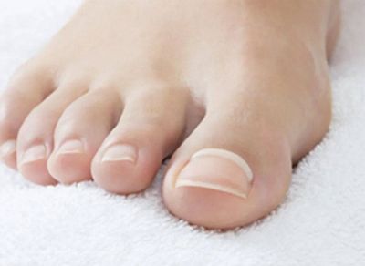 Effective Onyfix Nail Bracing | Foot Foundation