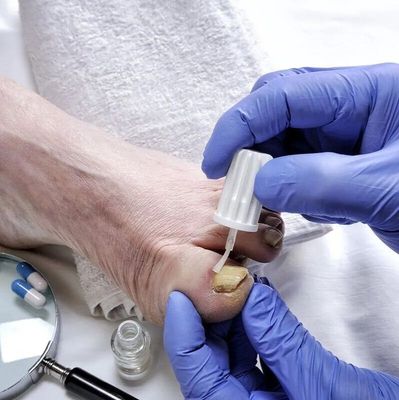 Topical Treatments | Cosmetic Nail Solutions