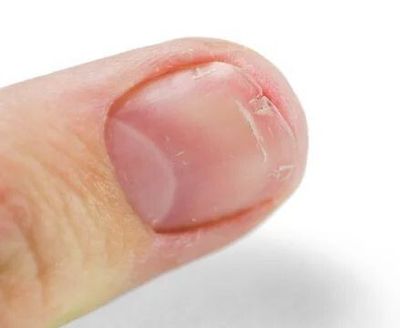 Splitting Nails | Cosmetic Nail Solutions