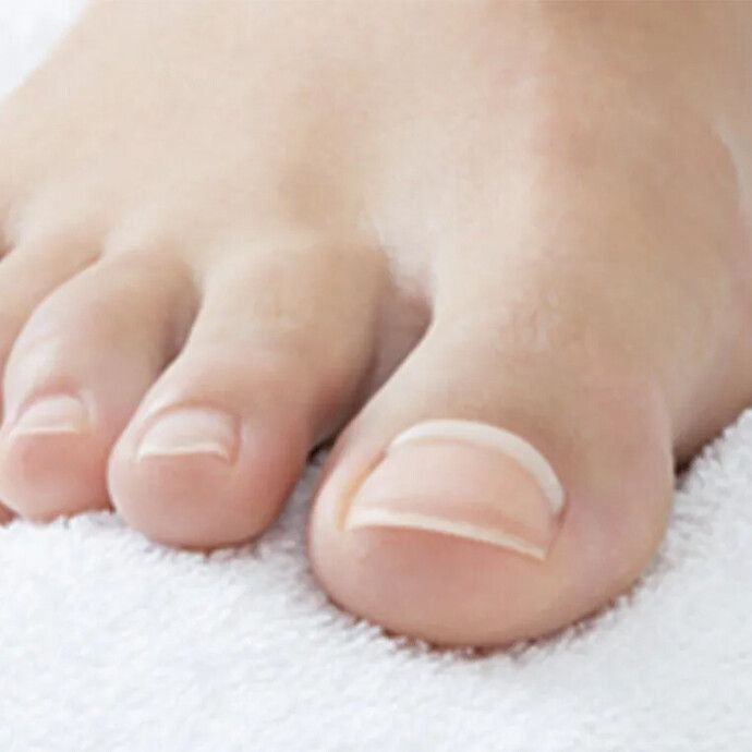 Ingrown Toenail Treatment | Ingrown Toenail Solutions