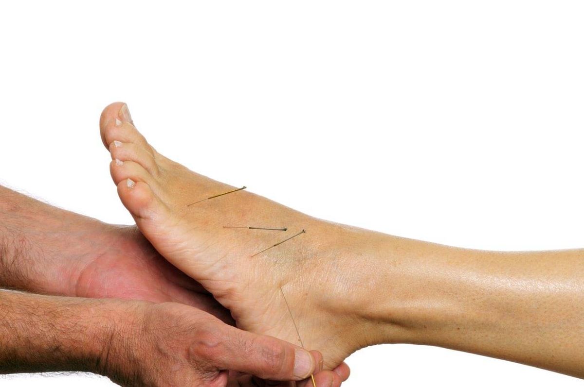 Effective Dry Needling for Foot and Ankle | Foot Foundation