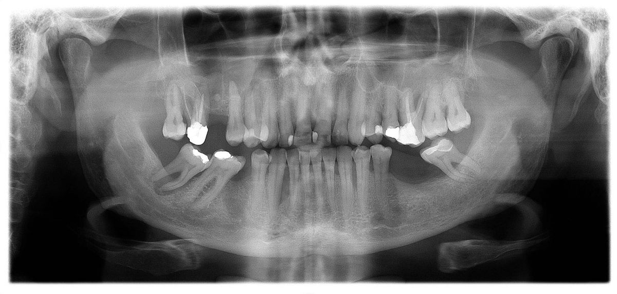 New Patients Welcome - Tooth Wear Treatment in Auckland, NZ
