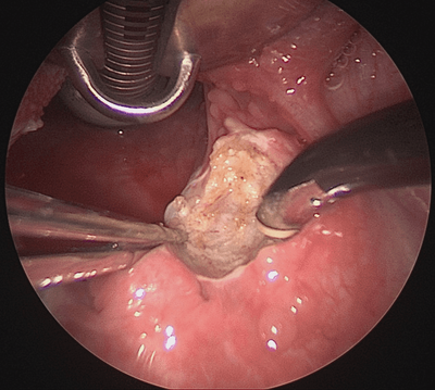 Coblation Procedures Palmerston North | ENT Central