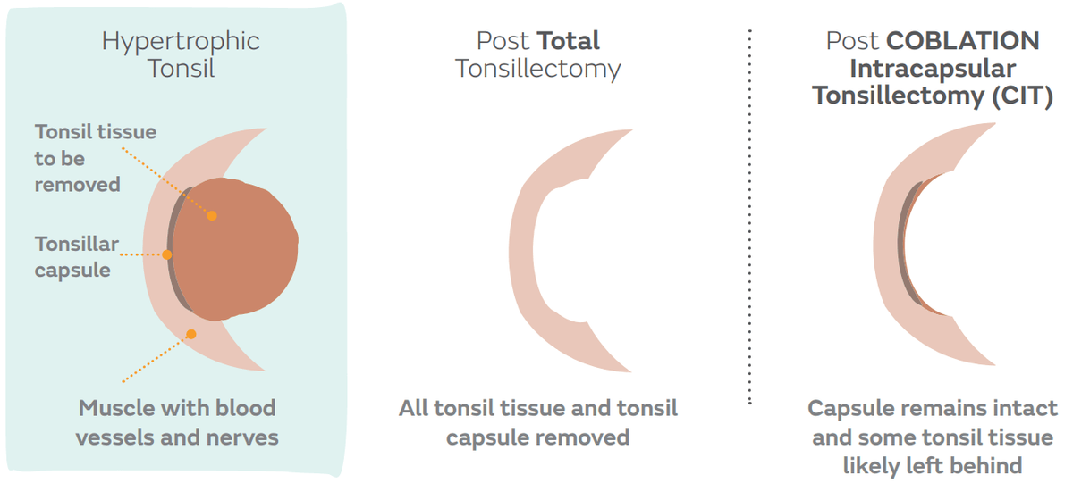 Coblation Tonsillectomy | ENT Central