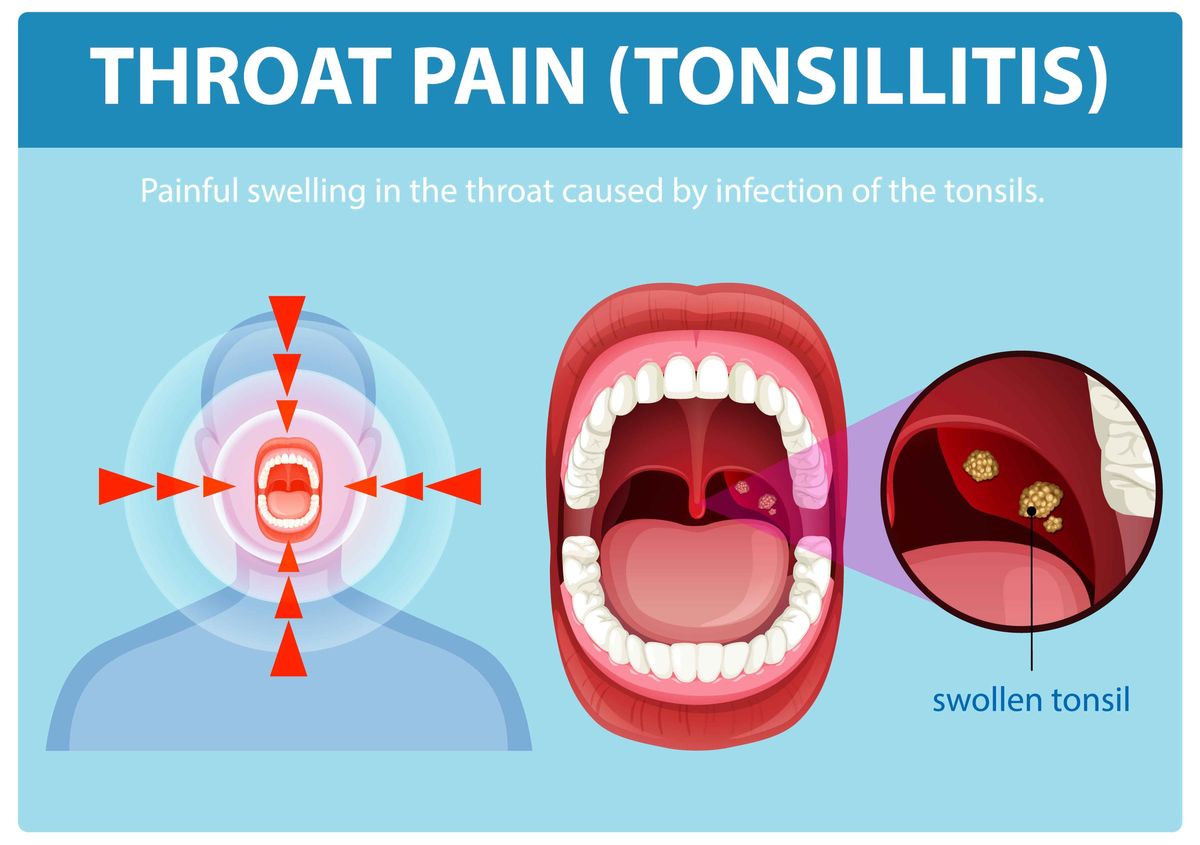 Tonsils Palmerston North | ENT Central