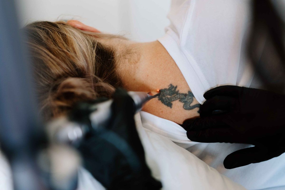Laser Tattoo Removal Morrinsville | Waikato Tattoo Removal
